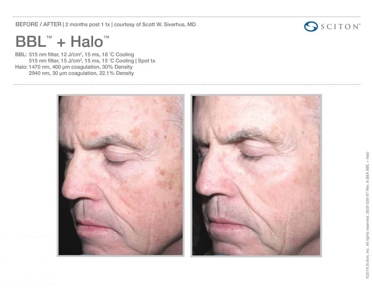 HALO Hybrid Fractional Laser | Buckhead Plastic Surgery