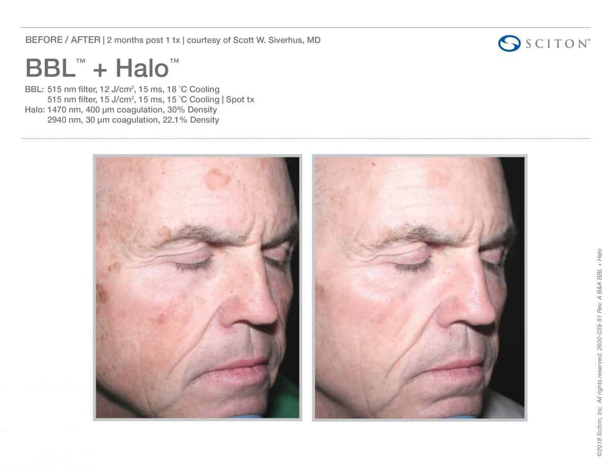 HALO Hybrid Fractional Laser | Buckhead Plastic Surgery