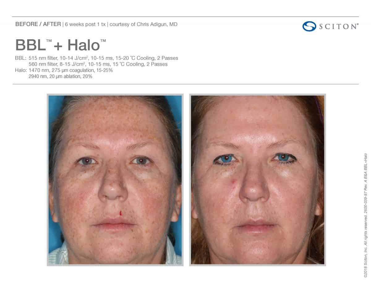 HALO Hybrid Fractional Laser | Buckhead Plastic Surgery