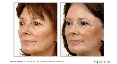 Contour TRL for a Flawless Youthful Complexion