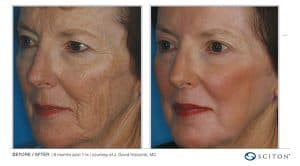 Contour TRL for a Flawless Youthful Complexion