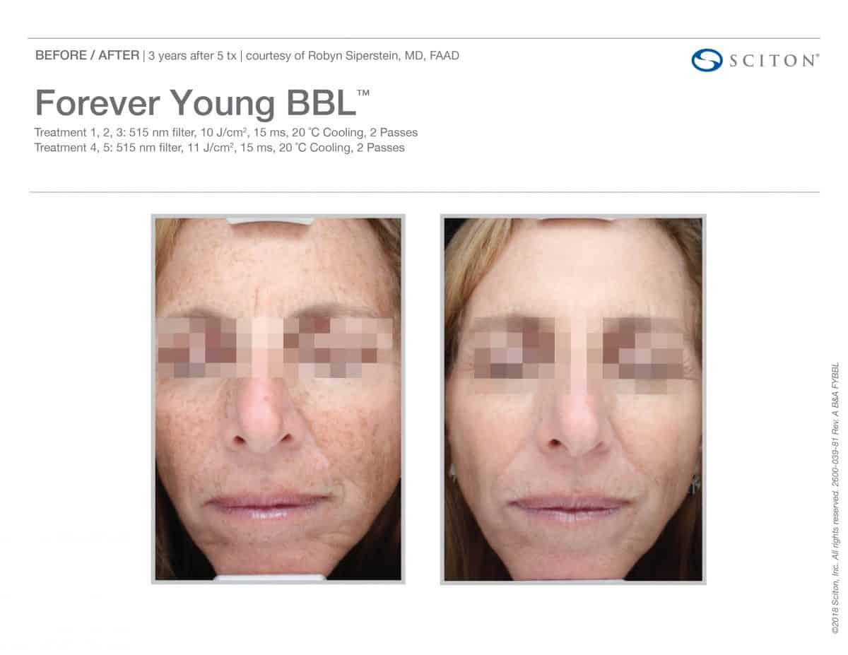 BBL BroadBand Light Treatments in Atlanta | Buckhead Plastic Surgery