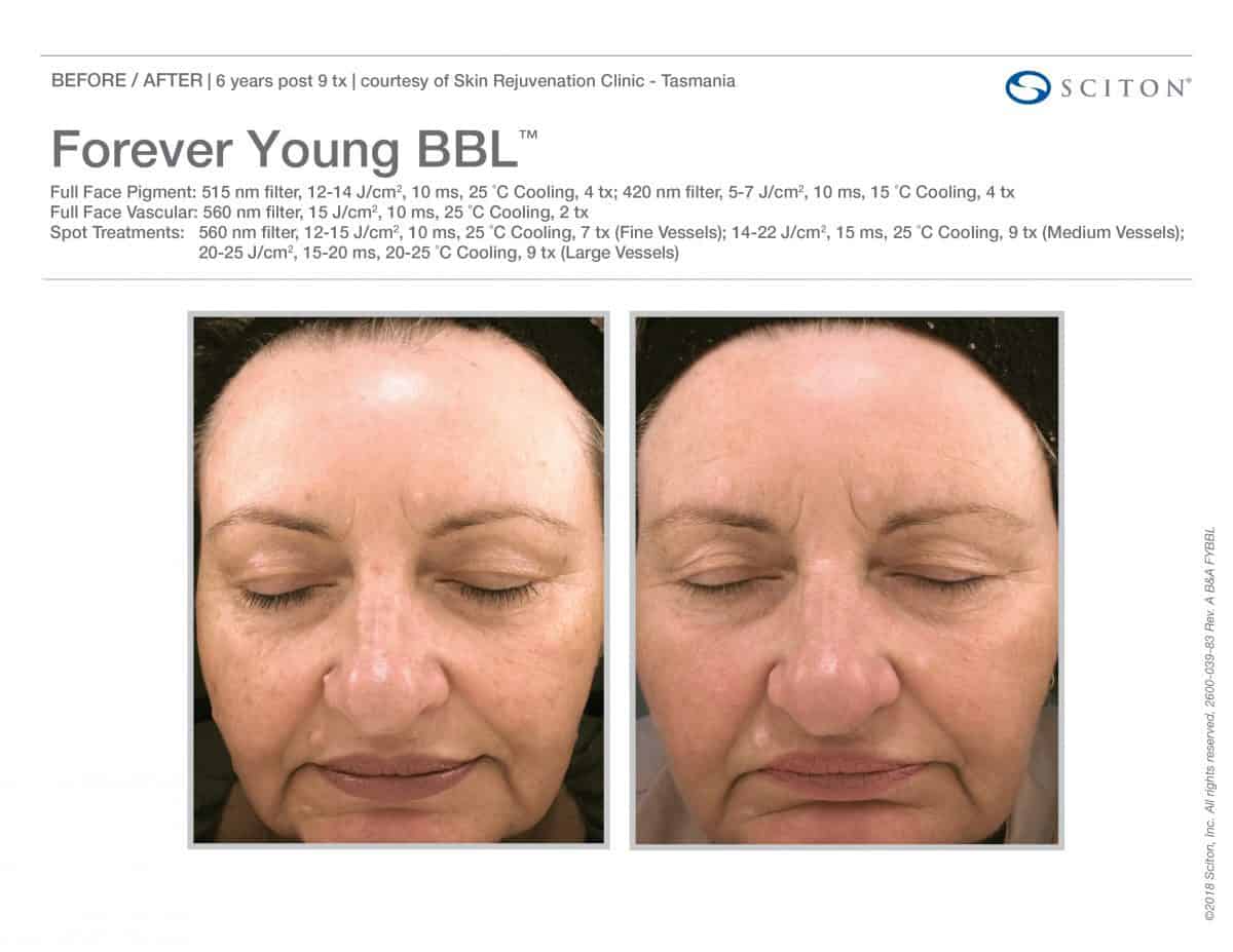 BBL BroadBand Light Treatments in Atlanta | Buckhead Plastic Surgery