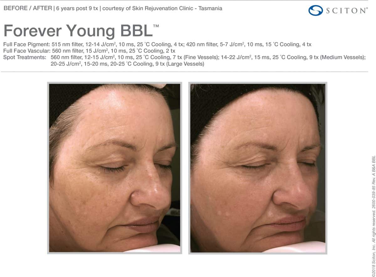 BBL BroadBand Light Treatments in Atlanta | Buckhead Plastic Surgery
