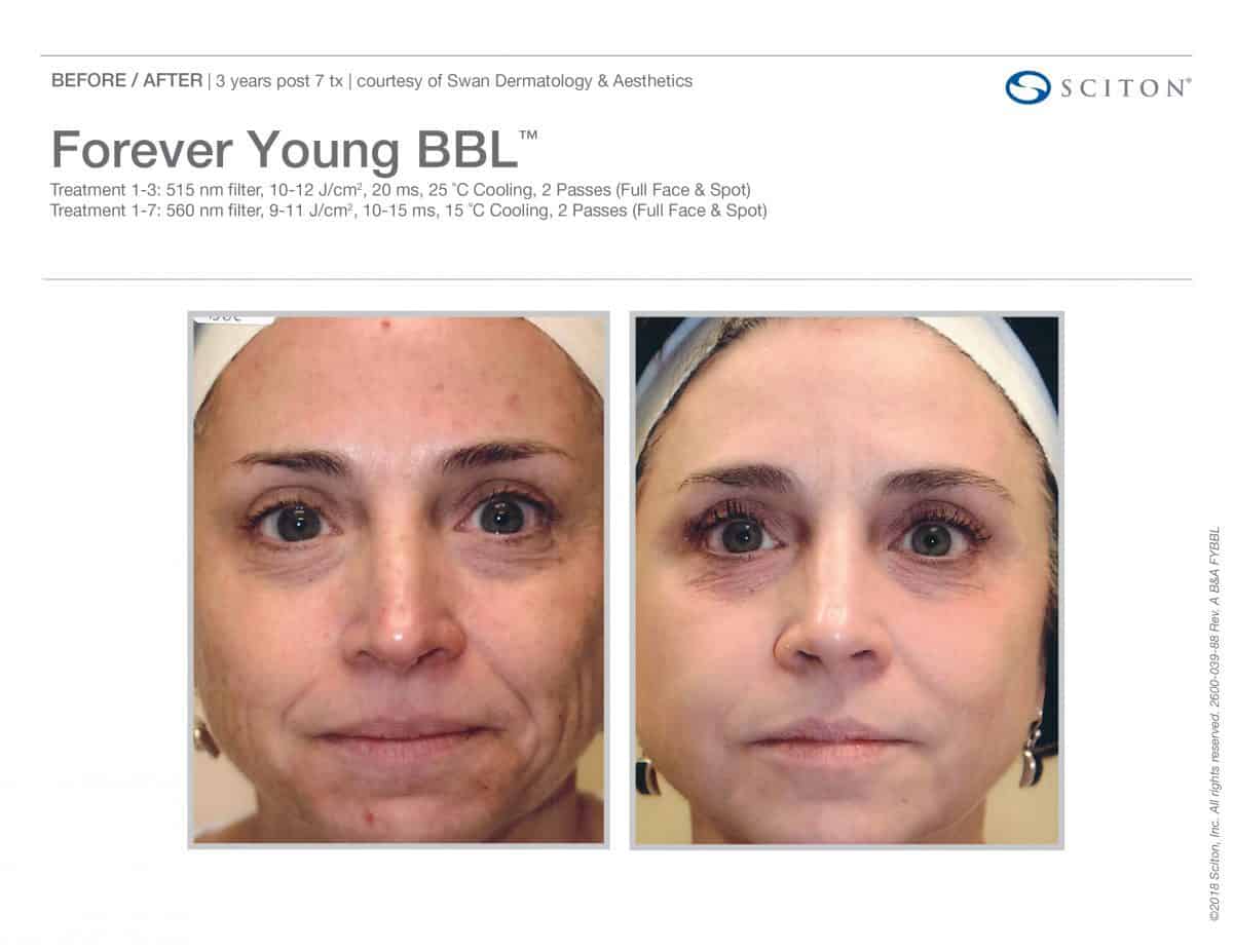 BBL BroadBand Light Treatments in Atlanta | Buckhead Plastic Surgery