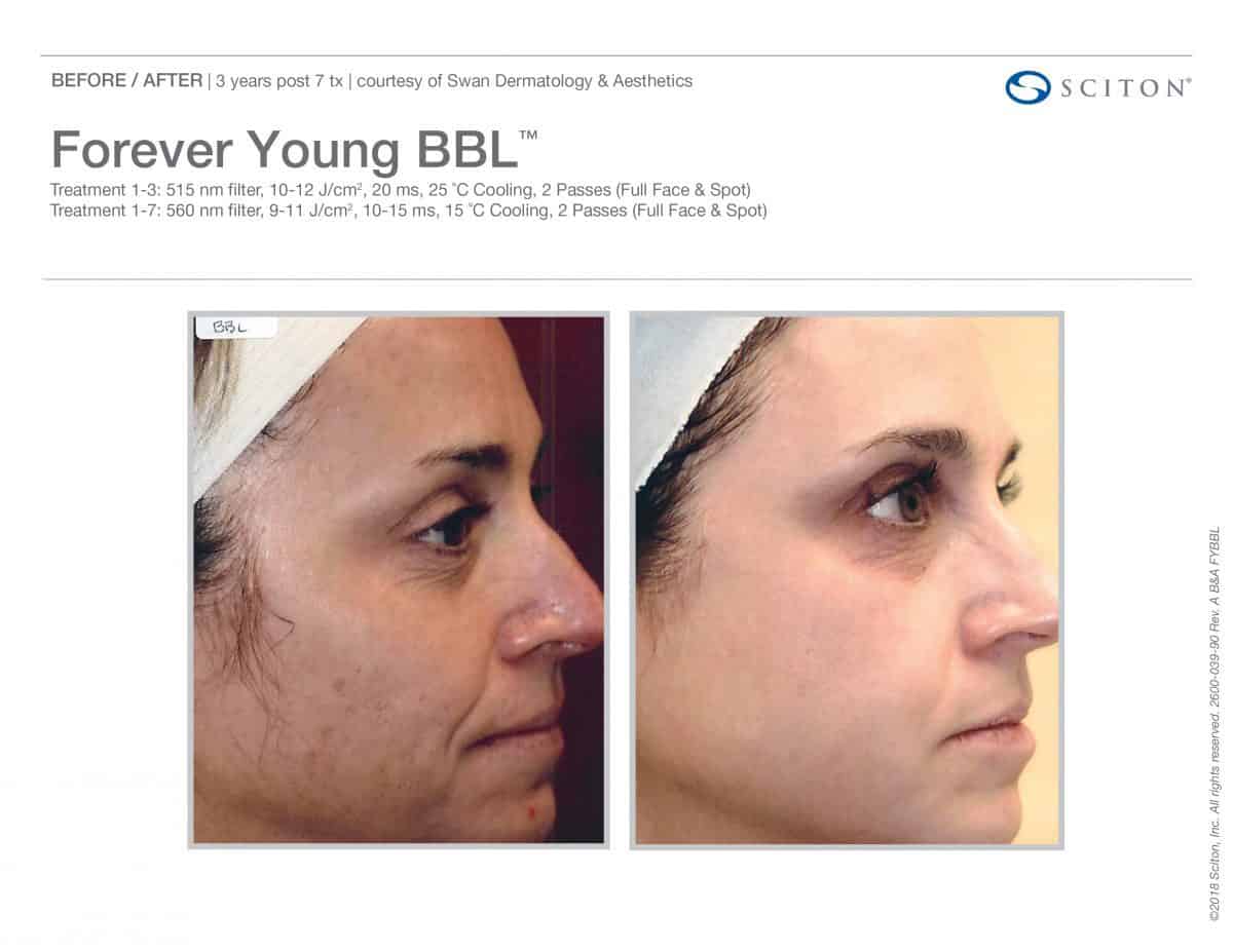 BBL BroadBand Light Treatments in Atlanta | Buckhead Plastic Surgery