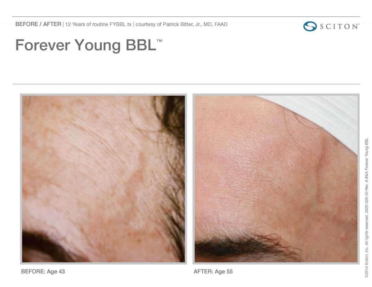 BBL BroadBand Light Treatments in Atlanta | Buckhead Plastic Surgery