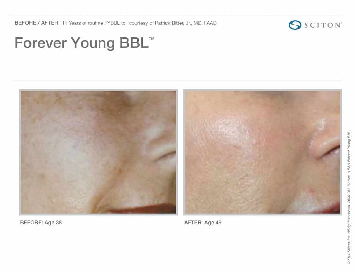BBL BroadBand Light Treatments in Atlanta | Buckhead Plastic Surgery