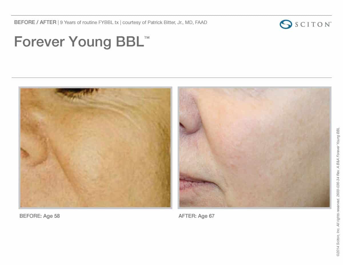 BBL BroadBand Light Treatments in Atlanta | Buckhead Plastic Surgery