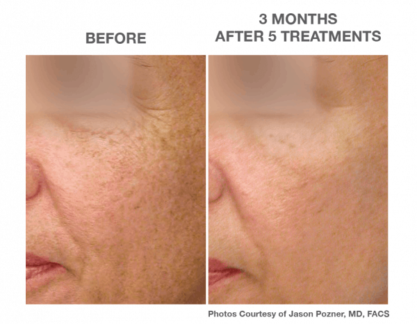 Contour TRL for a Flawless Youthful Complexion