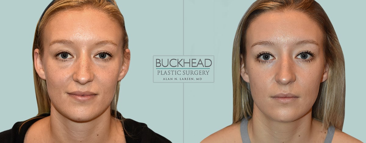 Double Board-Certified Atlanta Plastic Surgeon Dr. Alan Larsen