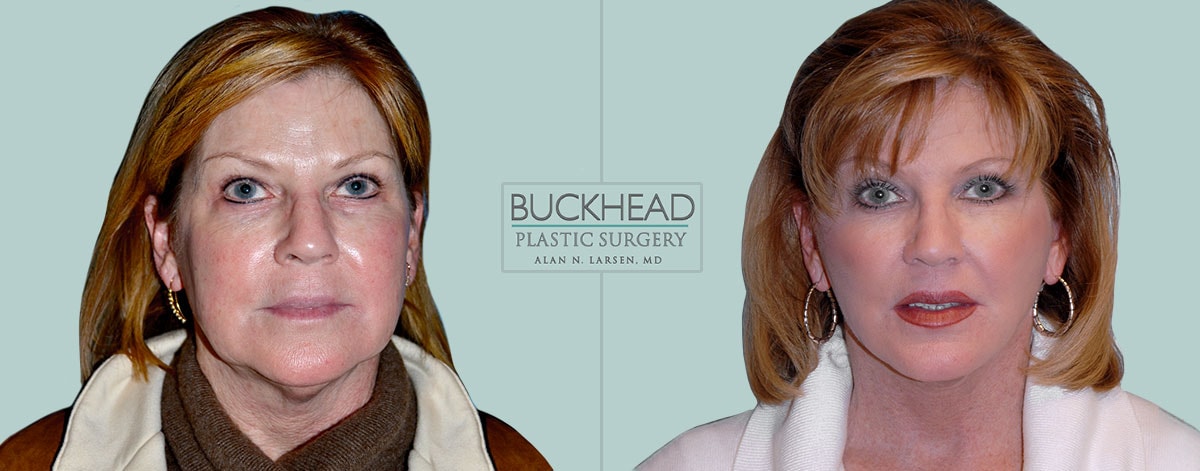 Double Board-Certified Atlanta Plastic Surgeon Dr. Alan Larsen