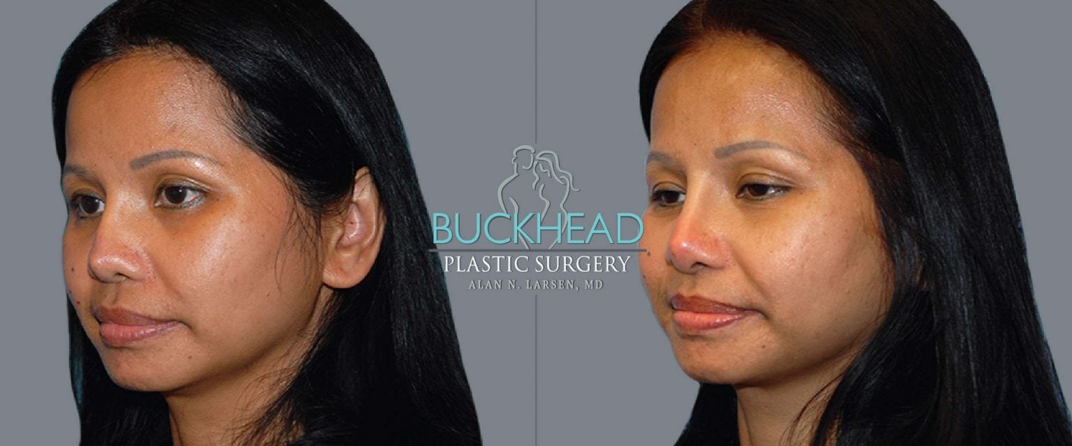 Rhinoplasty | Buckhead Plastic Surgery | Atlanta GA