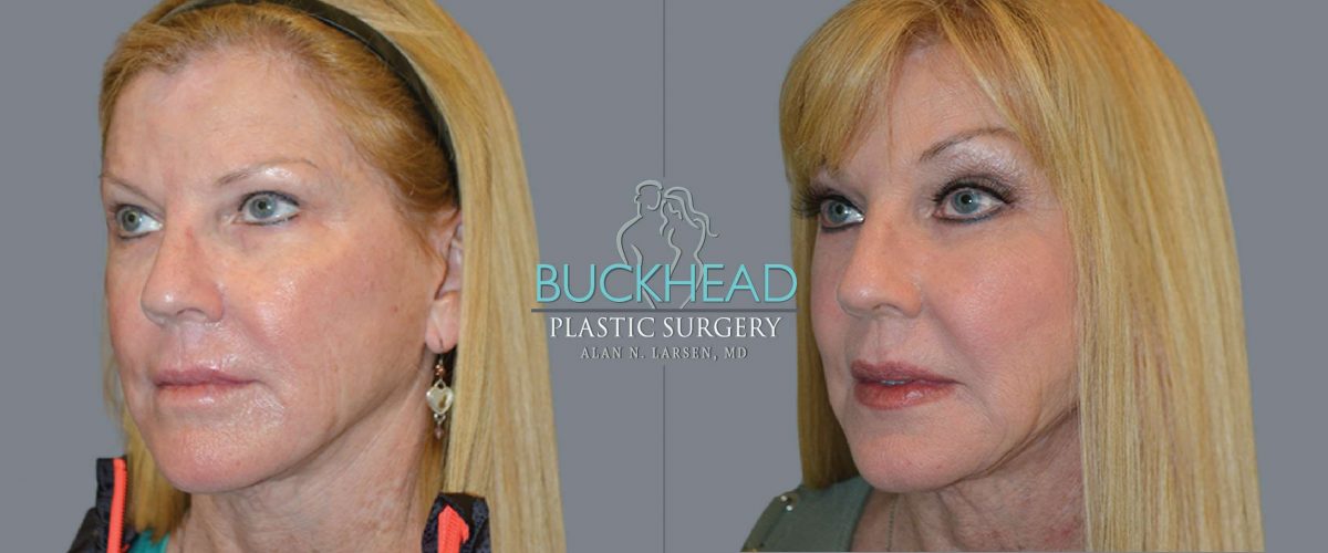 Eyelid Surgery | Buckhead Plastic Surgery | Atlanta GA