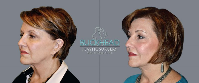Double Board-Certified Atlanta Plastic Surgeon Dr. Alan N Larsen