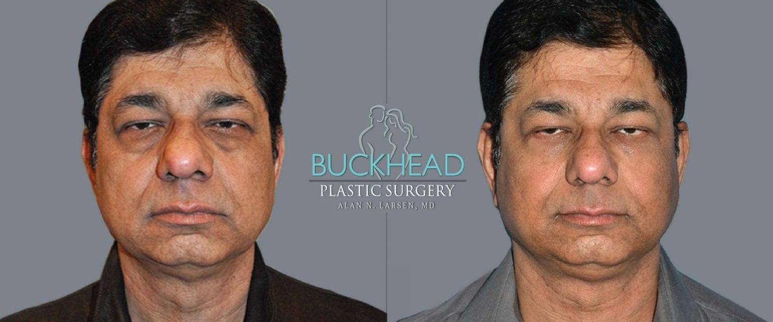 Surgery for Men | Buckhead Plastic Surgery | Atlanta GA