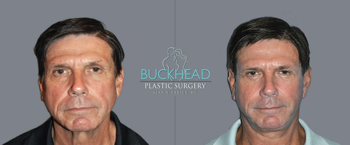 Surgery for Men | Buckhead Plastic Surgery | Atlanta GA