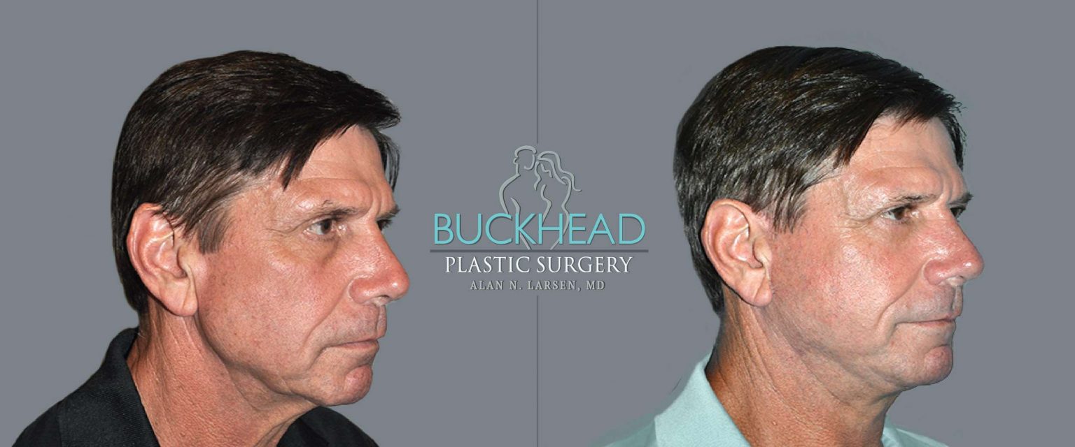 Facelift & Neck Lift | Buckhead Plastic Surgery | Atlanta GA