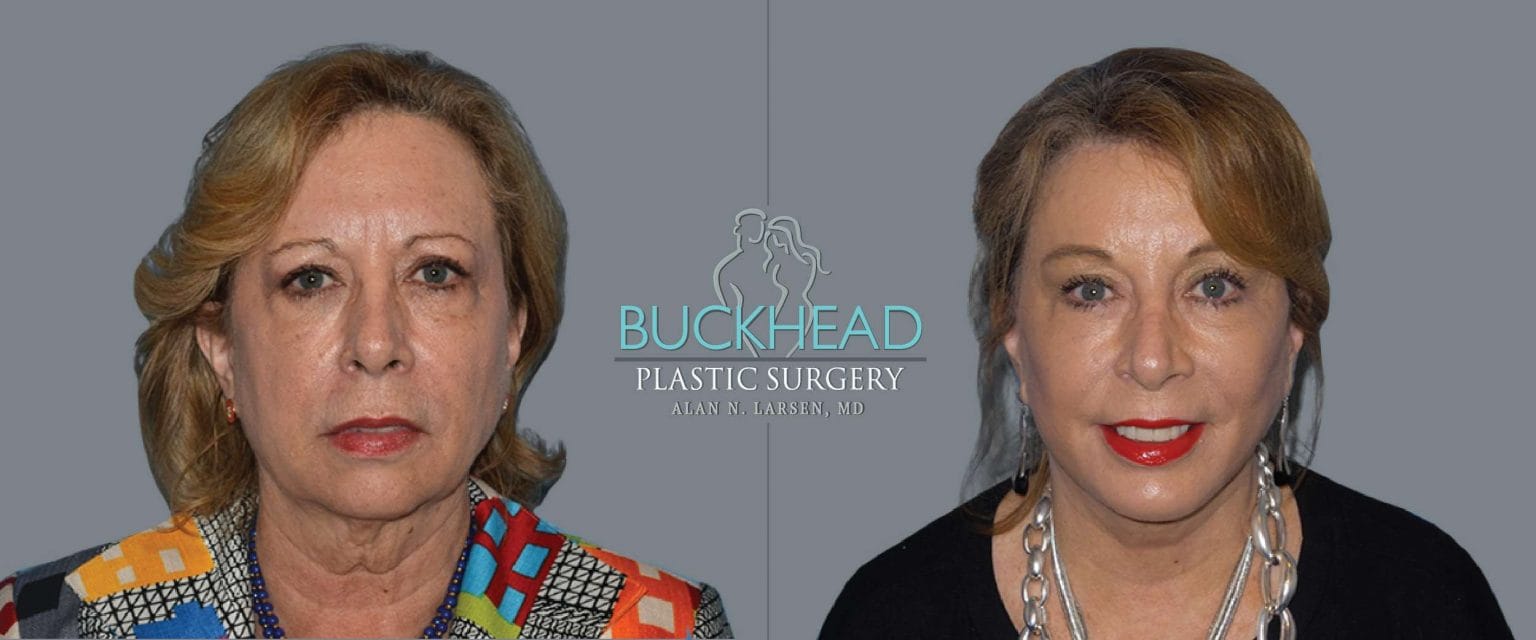 Double Board-Certified Atlanta Plastic Surgeon Dr. Alan N Larsen
