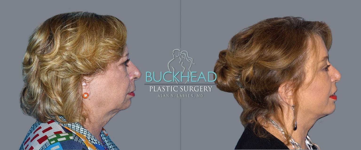 Chin Augmentation | Buckhead Plastic Surgery | Atlanta GA