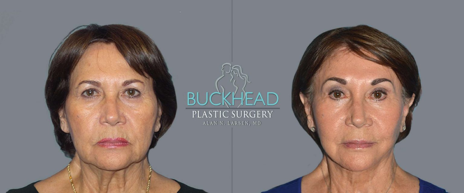 Facelift & Neck Lift | Buckhead Plastic Surgery | Atlanta GA
