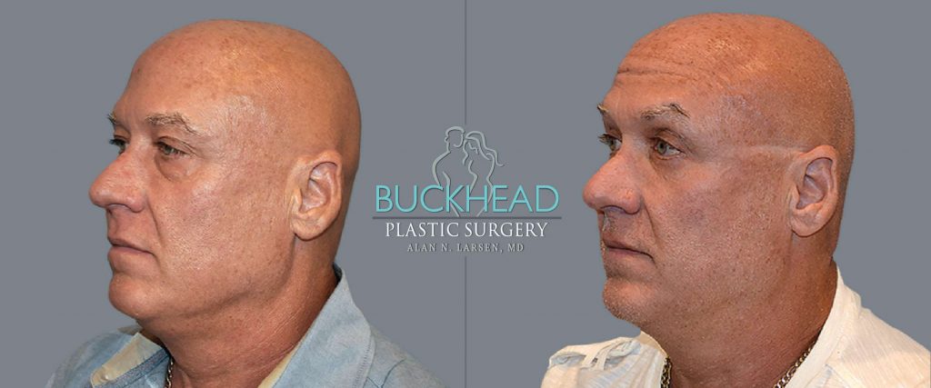 Eyelid Surgery | Buckhead Plastic Surgery | Atlanta GA