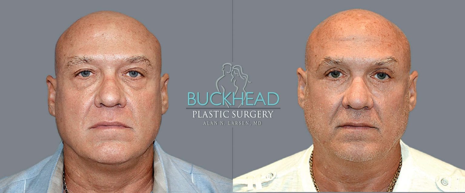 Double Board-Certified Atlanta Plastic Surgeon Dr. Alan N Larsen