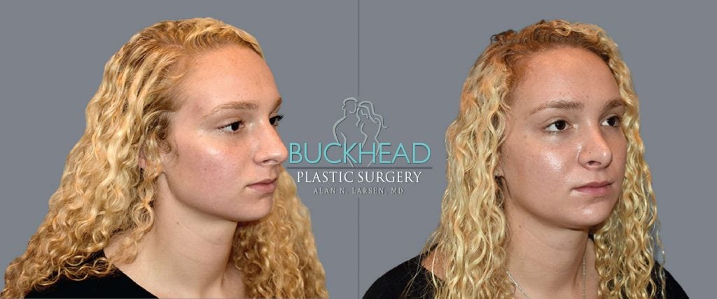 Rhinoplasty | Buckhead Plastic Surgery | Atlanta GA