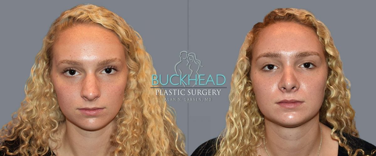Rhinoplasty | Buckhead Plastic Surgery | Atlanta GA