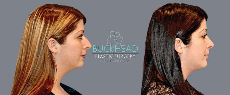 Double Board-Certified Atlanta Plastic Surgeon Dr. Alan N Larsen