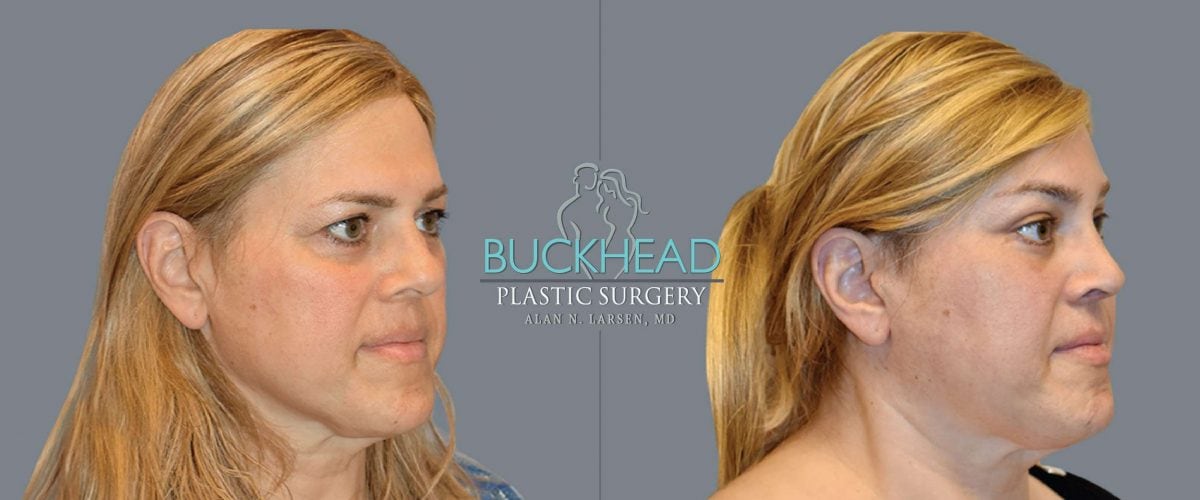 Brow Lift | Buckhead Plastic Surgery | Atlanta GA
