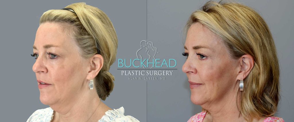 Eyelid Surgery | Buckhead Plastic Surgery | Atlanta GA