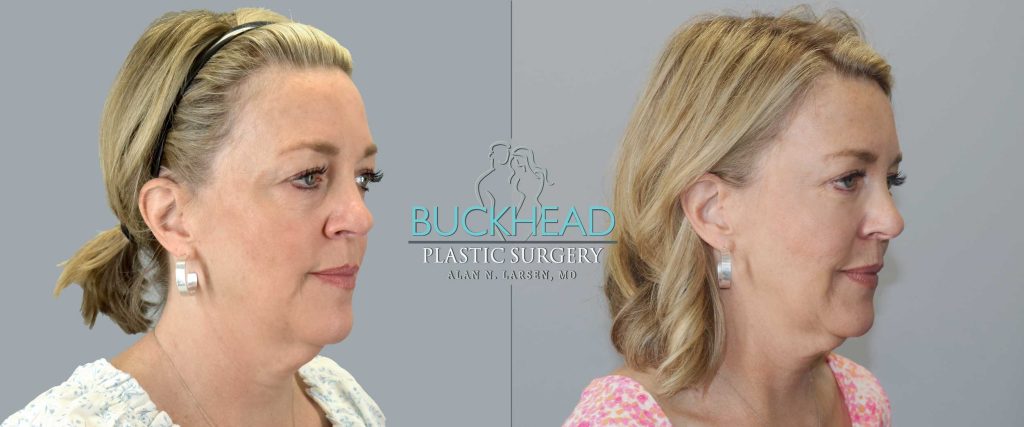 Eyelid Surgery | Buckhead Plastic Surgery | Atlanta GA