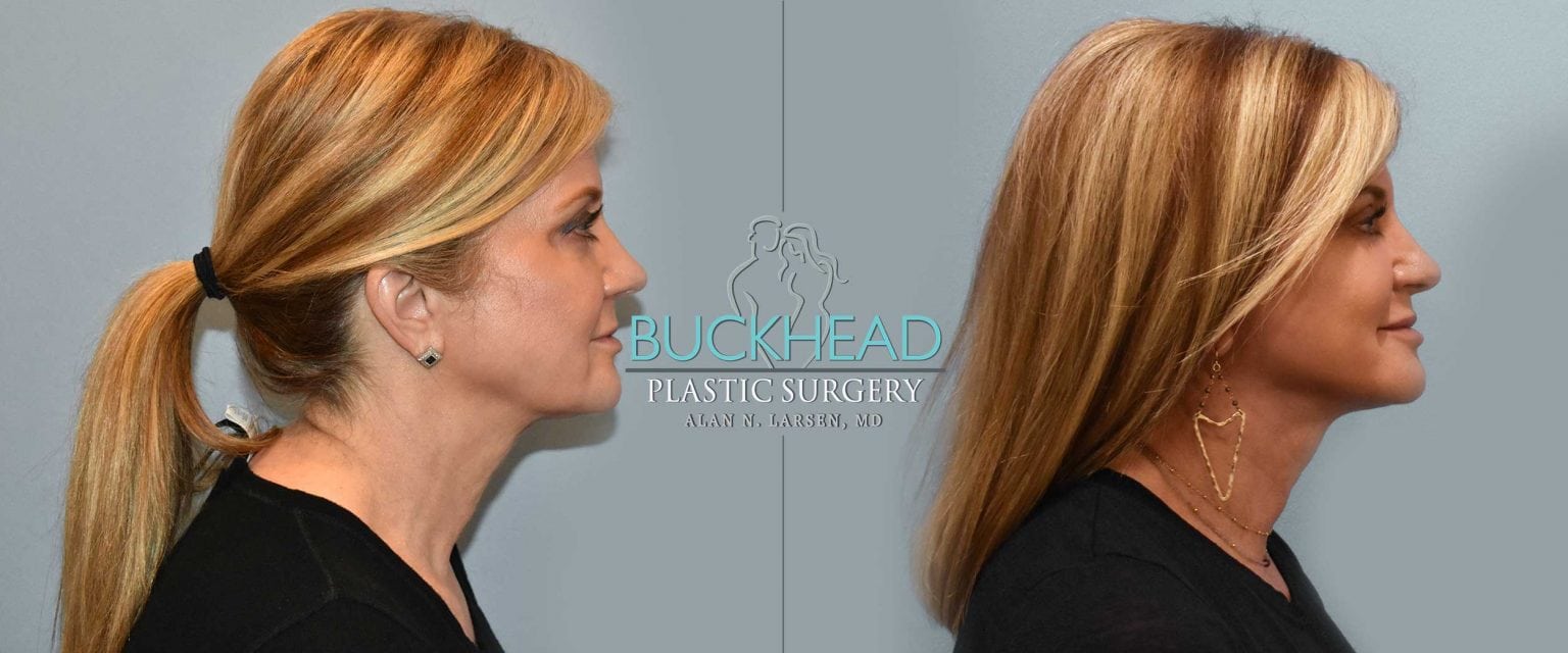 Facelift & Neck Lift | Buckhead Plastic Surgery | Atlanta GA