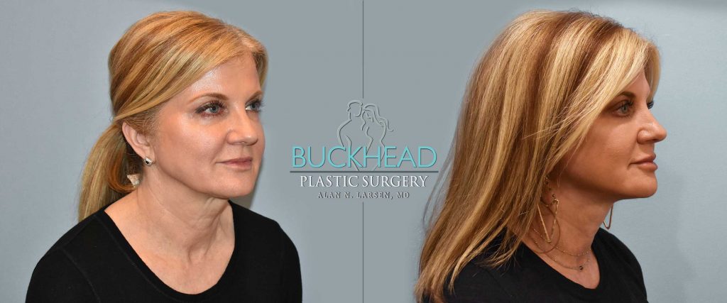 Facelift & Neck Lift | Buckhead Plastic Surgery | Atlanta GA