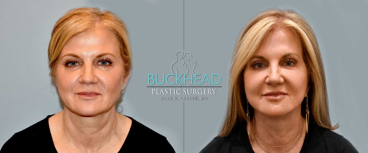 Facelift & Neck Lift | Buckhead Plastic Surgery | Atlanta GA