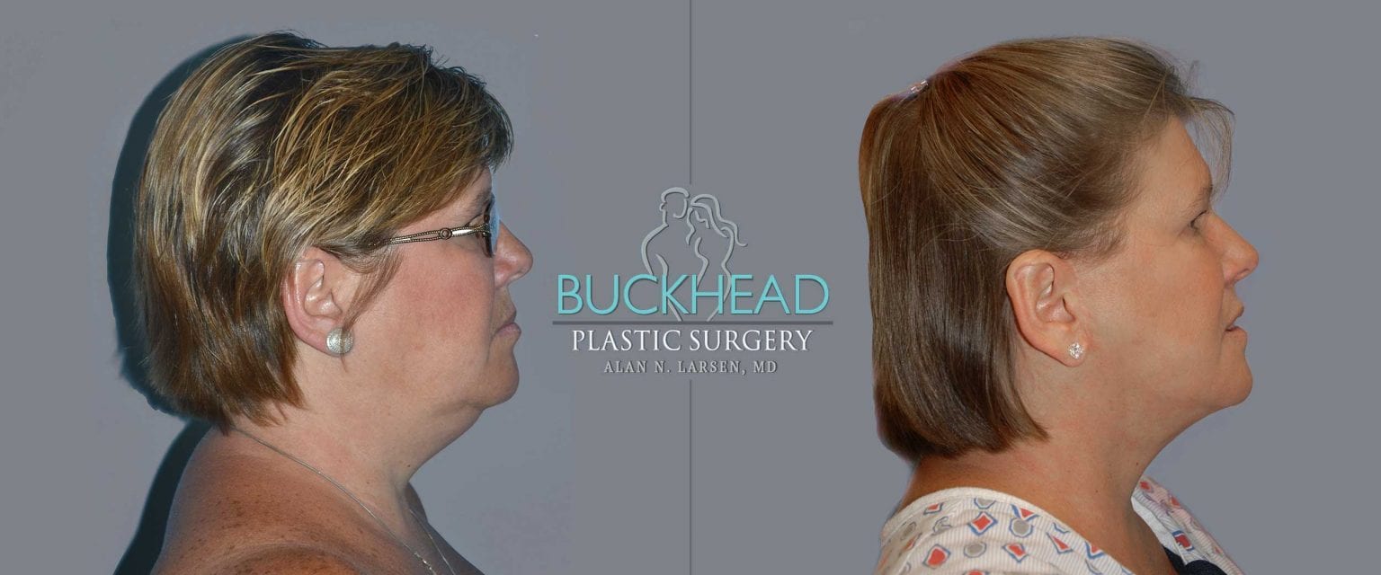 Facelift & Neck Lift | Buckhead Plastic Surgery | Atlanta GA