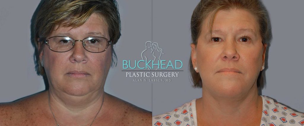 Facelift & Neck Lift | Buckhead Plastic Surgery | Atlanta GA
