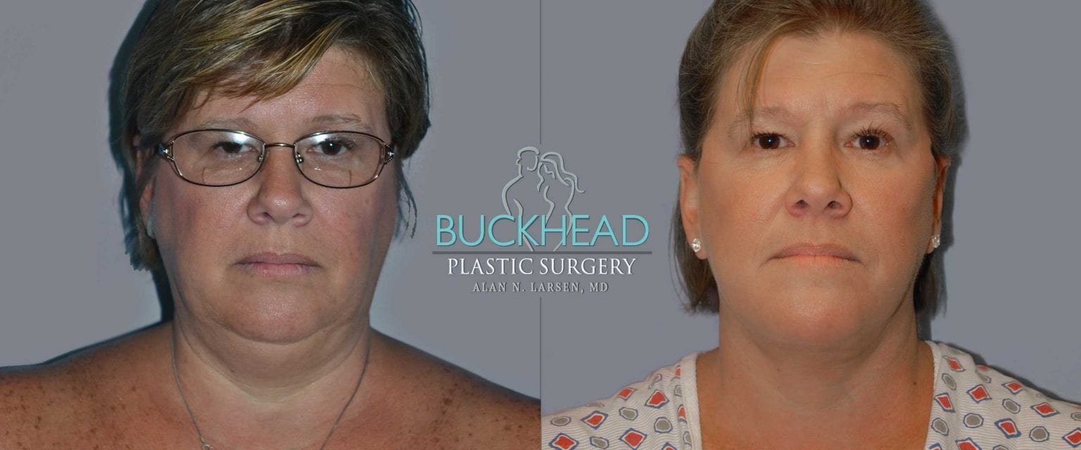 Facelift & Neck Lift | Buckhead Plastic Surgery | Atlanta GA
