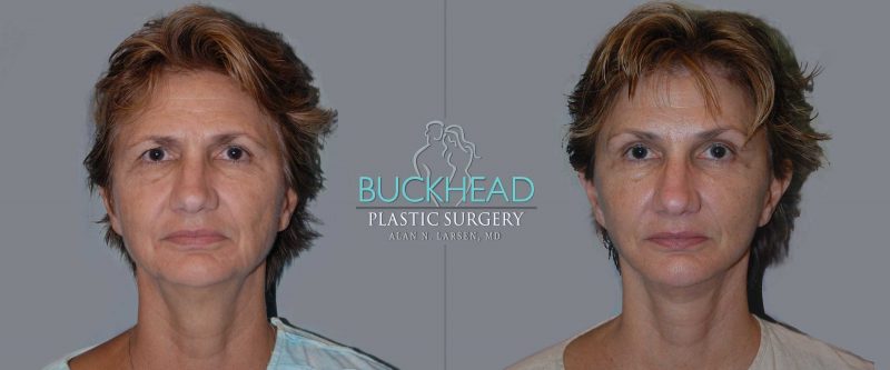 Facelift & Neck Lift | Buckhead Plastic Surgery | Atlanta GA