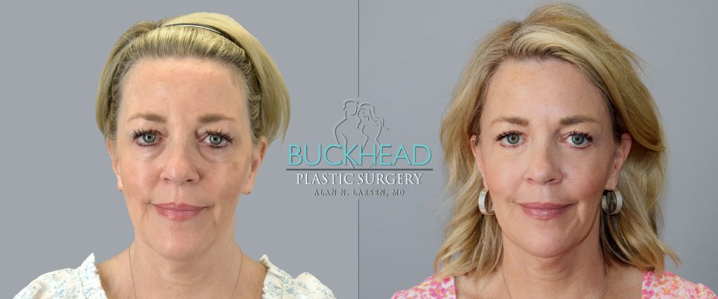 Eyelid Surgery | Buckhead Plastic Surgery | Atlanta GA