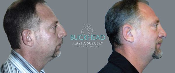 Chin Augmentation | Buckhead Plastic Surgery | Atlanta GA