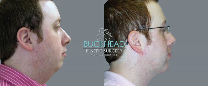Chin Augmentation | Buckhead Plastic Surgery | Atlanta GA