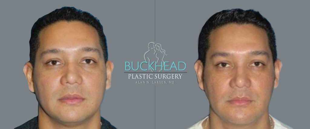 Chin Augmentation | Buckhead Plastic Surgery | Atlanta GA