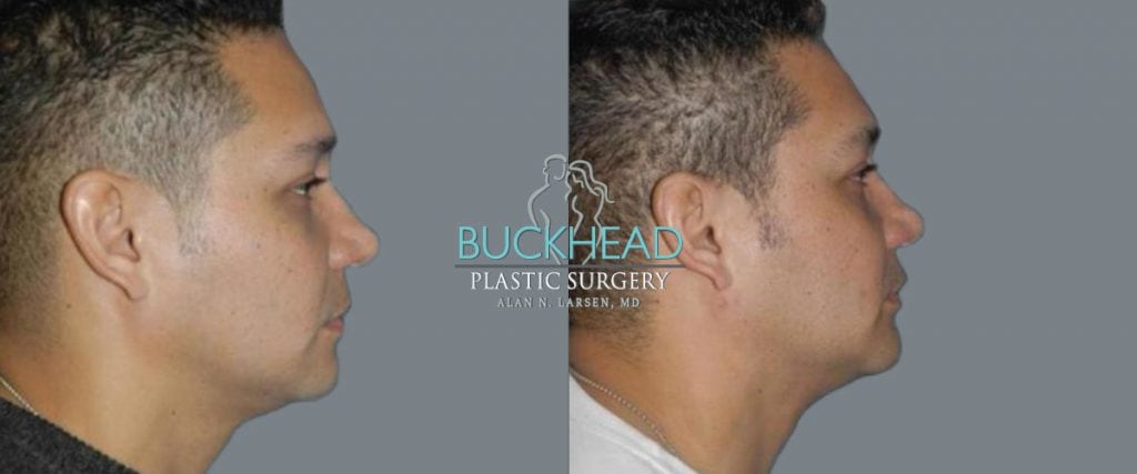Chin Augmentation | Buckhead Plastic Surgery | Atlanta GA