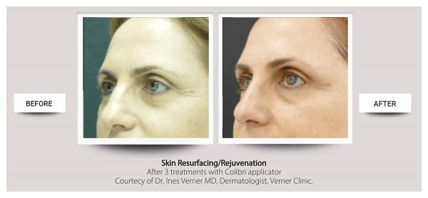 Accent Prime | Body Contouring | Buckhead Plastic Surgery