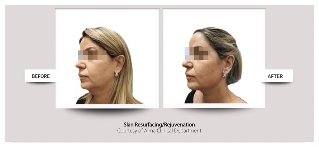 Accent Prime | Body Contouring | Elite at Buckhead Plastic Surgery