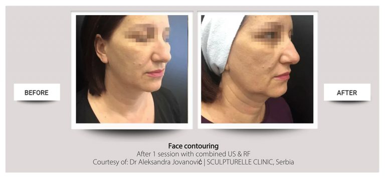 Accent Prime | Body Contouring | Buckhead Plastic Surgery
