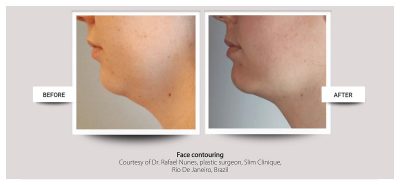 Accent Prime | Body Contouring | Buckhead Plastic Surgery