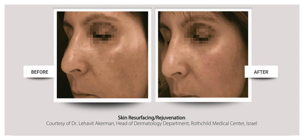 Accent Prime | Body Contouring | Buckhead Plastic Surgery